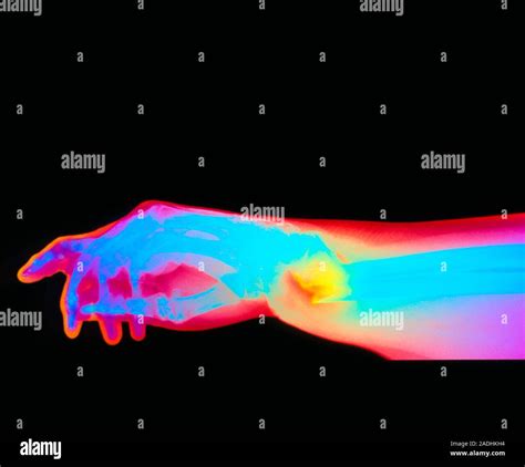 Osteoporosis Wrist Fracture Coloured X Ray Of A Colles Fracture To