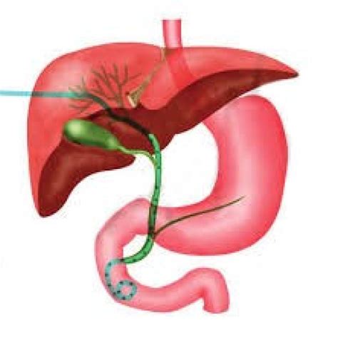 Naar Huis Met Een Percutane Galwegdrain Ptc St Antonius Ziekenhuis
