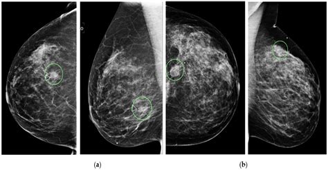 Improving Performance Of Breast Lesion Classification Using A Resnet50 Model Optimized With A