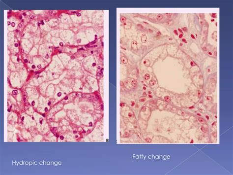 Interpretation Of Renal Biopsy Pptx