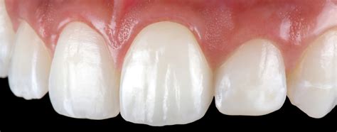 Zirconia Crowns Cementation