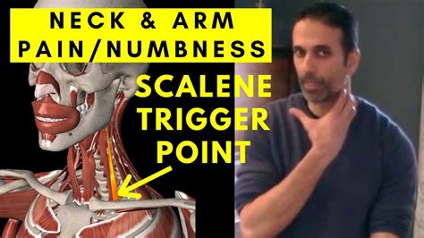 Scalene Muscles Trigger Points