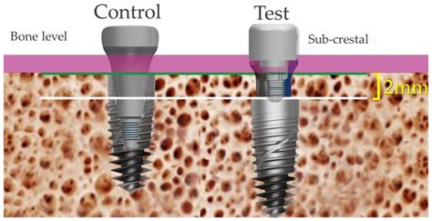 Subcrestal Versus Bone Level One Stage Implants Early Bone And Soft
