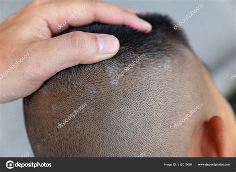 Scalp Skin Conditions