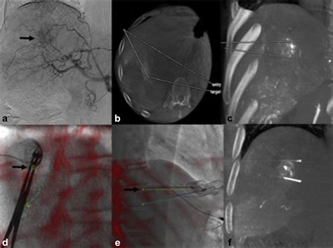 Safety And Efficacy Of Combined Transarterial Embolization And Percutaneous Radiofrequency