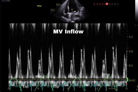 Cardiac Tamponade 2d Echo Doppler And The Hemodynamic Cascade