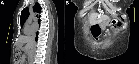 Heterotopic Ossification Of The Xiphoid After Chest Compressions The Annals Of Thoracic Surgery