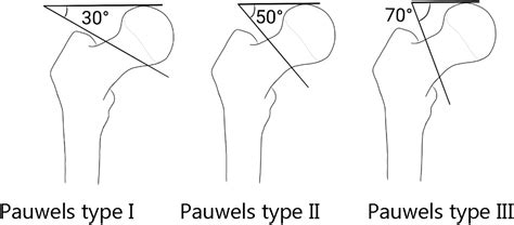 Classification Of Hip Fracture At Bennie Morris Blog