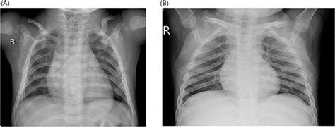 Chest X Ray Pneumonia