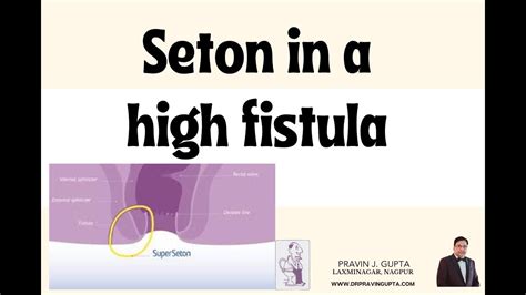 Loose Draining Seton In A High Anal Fistula Youtube