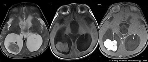 Miles To Read B4 I Sleep P Choroid Plexus Papilloma