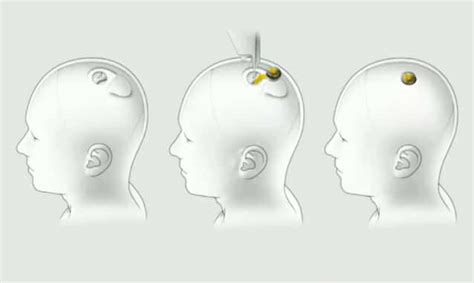 일론 머스크 뇌에 컴퓨터 칩 심은 돼지 공개 Zdnet Korea