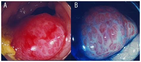 Preoperative Colonoscopy The Surface Color Was Red And The Pit Pattern