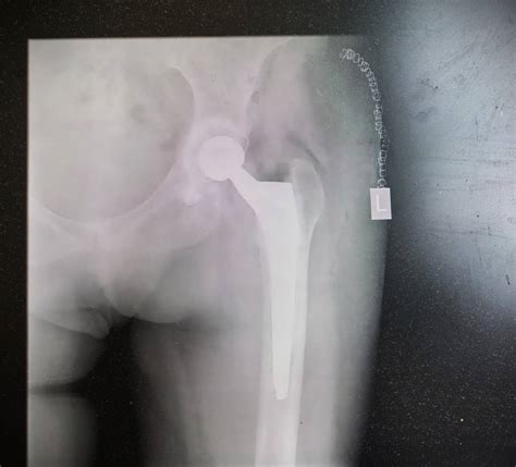 Апробация эндопротеза тазобедренного сустава Анатомика в ПИМУ