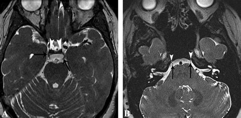 Recurrent Adrenocorticotropic Hormone Pituitary Adenoma The Patient
