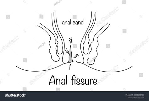 Small Tear Tear Lining Anal Canal Stock Vector Royalty Free