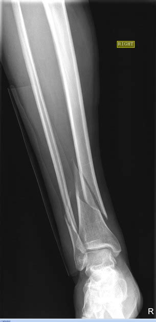 Spiral Fractures