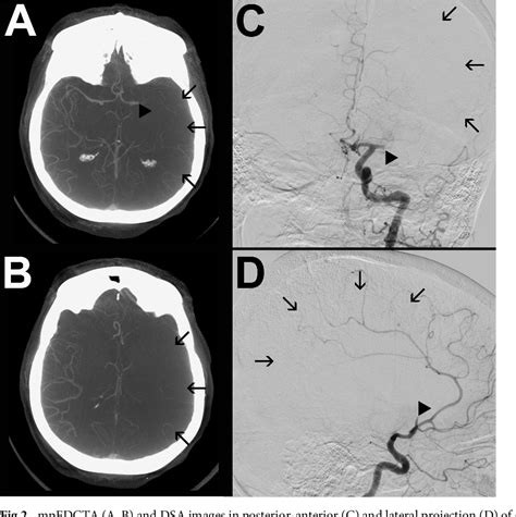 Table 1 From Validation Of Collateral Scoring On Flat Detector Multiphase Ct Angiography In
