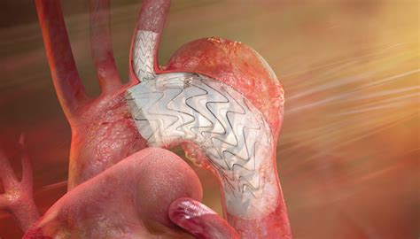 Gore Launches Trial For Tag Thoracic Branch Endoprosthesis Massdevice