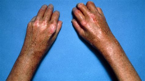 10 Diabetes Related Skin Problems