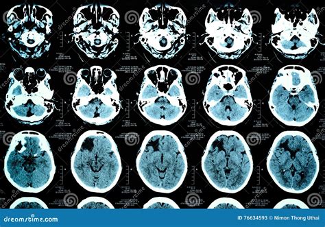 Images From A Computerized Tomography Stock Image Image Of Organ