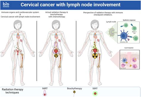 Frontiers The Abscopal Effect Of Immune Radiation Therapy In