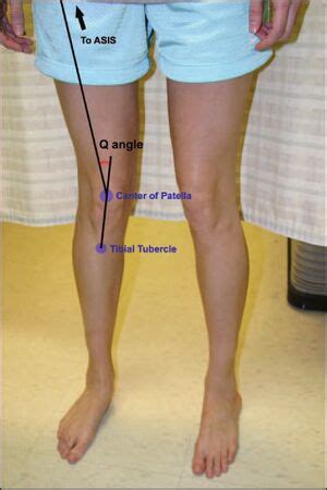 Q Angle Wikism Sports Medicine Wiki