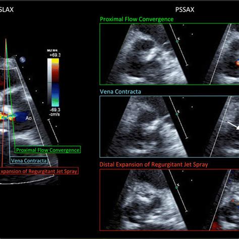 Pdf Severity Of Aortic Regurgitation Assessed By Area Of Vena