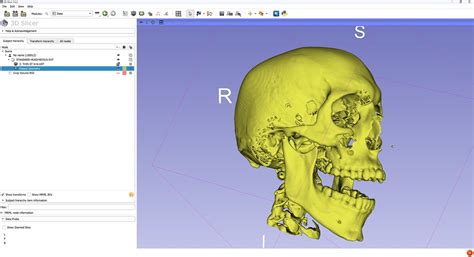 Methods For Thin Skull Bone Segmentation Support 3d Slicer Community