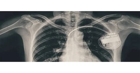 Dual Chamber Pacemaker Dr Abhijit Borse
