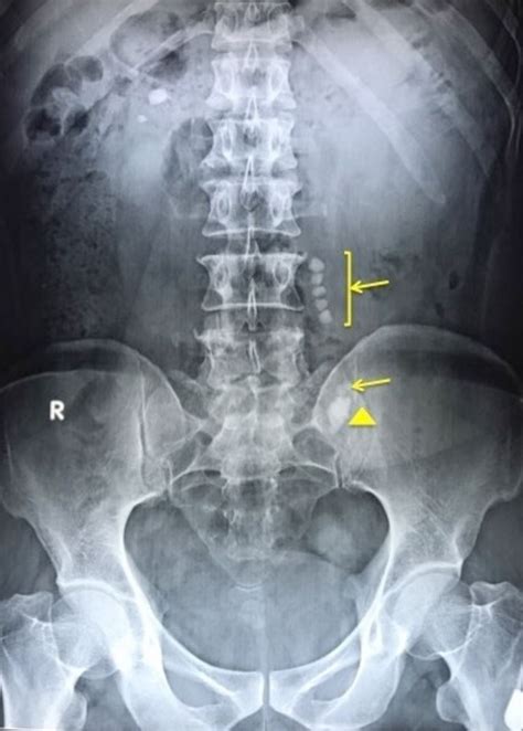 Chain Of Migrating Ureteral Calculi A Cat And Mouse Game Bmj Case Reports