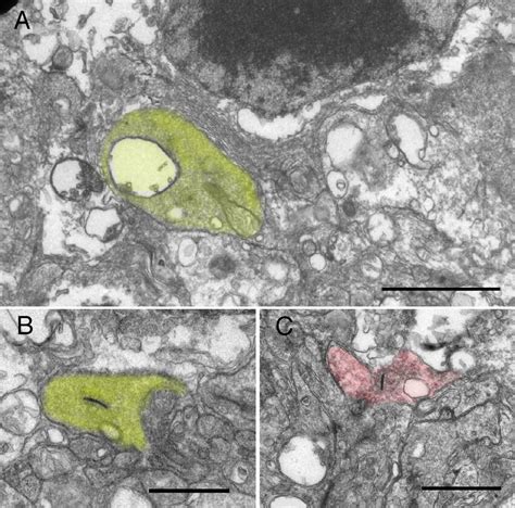 Normal Synaptic Contacts In The Outer Plexiform Layer Were Absent In