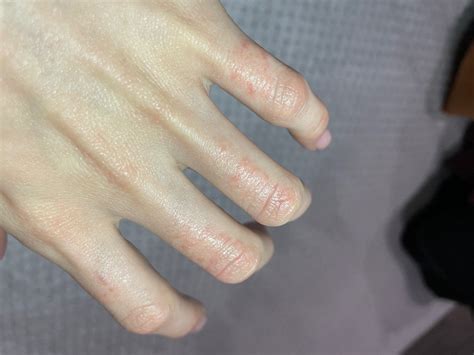 Красные пятна на пальцах рук Вопрос дерматологу 03 Онлайн