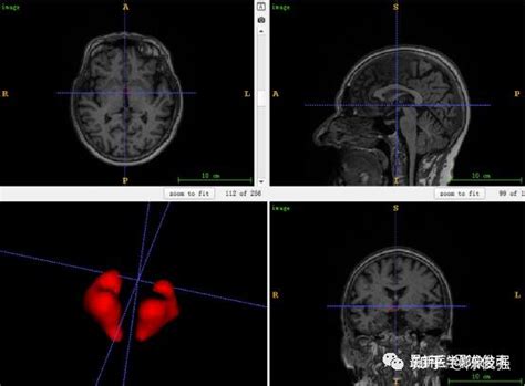 hypothalamus segmentation challenge2022 ——下丘脑，海马体及子区域分割 知乎