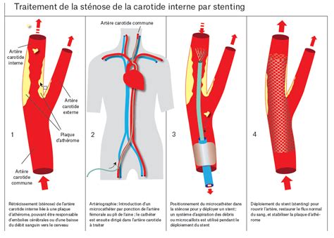 Comprendre Le Rôle Du Lymphocyte Hyperbasophile Dans Le Système