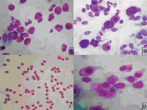 Figure 1 From Non Allergic Rhinitis With Eosinophils And Mast Cells
