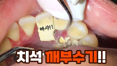 딱딱한 치석 속 하얀 치아 찾아내기 Youtube