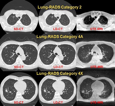 Pulmonary Mr Imaging With Ute Hasa Potential To Be Applied For Lung