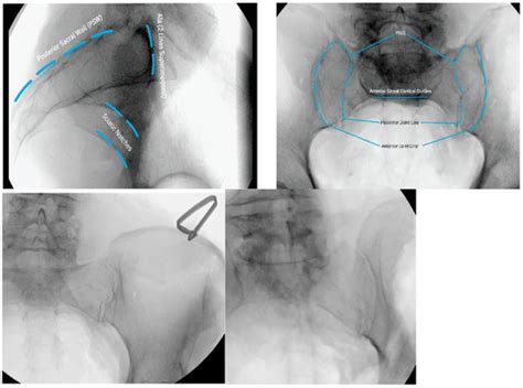 Sacral Sulcus Landmark