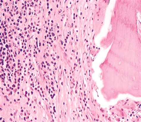 Osteomyelitis Adult Trauma Orthobullets