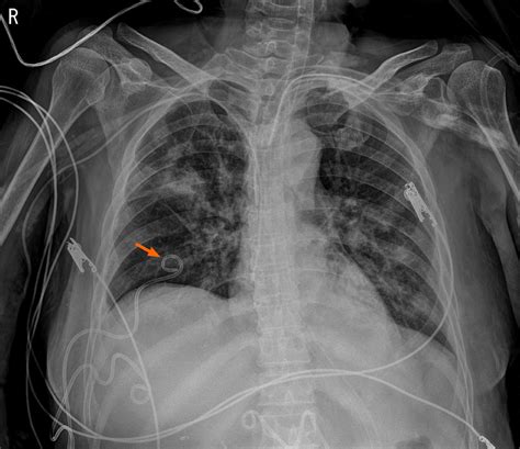Hemothorax Chest Tube