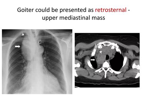 Thyroid Lesions Evaluation With Sonography Ppt