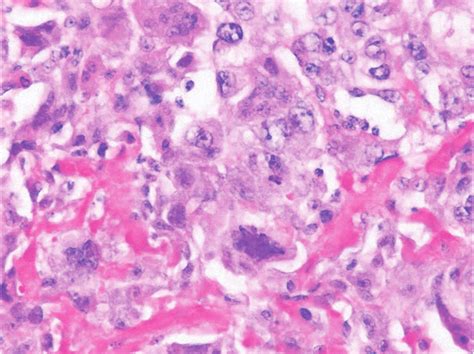 Osteoblastic Osteosarcoma Of Breast Showing Sheets Of Large Pleomorphic Download Scientific