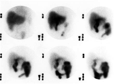 Representative Hepatobiliary Scintigraphy Recording In A Download