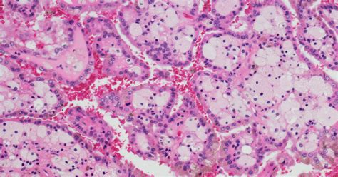 Papillary Renal Cell Carcinoma Risk Factors Signs Treatment Prognosis