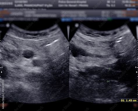 Ultrasound Of Urinary Bladder Or Kub For Screening Renal And Bladder