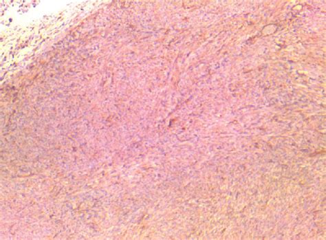 Immunohistochemical Findings Of The Case Of Angioleiomyoma Reported