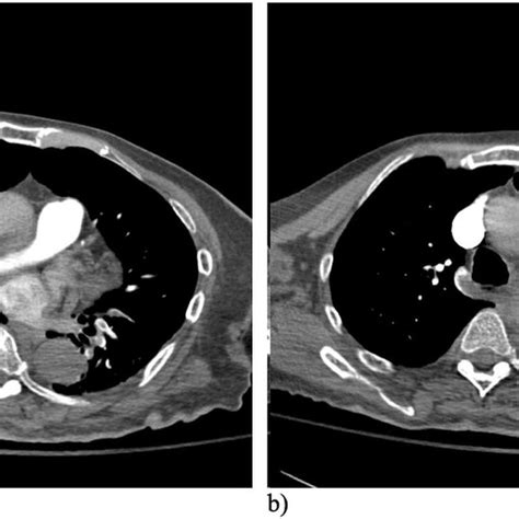 Axial Ct Angiography Showing Saddle Pulmonary Emboli With Evidence Of