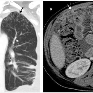 Mother A Chest Ct Coronal View Demonstrating Tree In Bud Pattern In Download Scientific