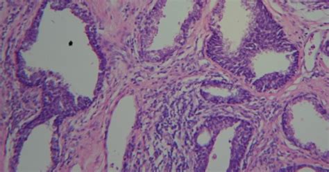 Healthy Prostatic Fluid Is Essential For Male Fertility Panaxea